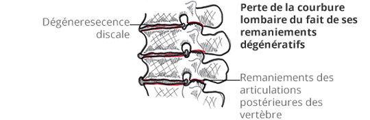 Chirurgie de déformation rachidienne scoliose - Centre du Rachis de la ...