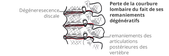 deformation-rachidienne-03 - Centre du Rachis de la Sauvegarde